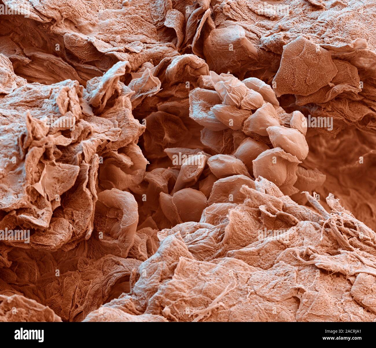 Psoriasis. Coloured scanning electron micrograph (SEM) of skin cells ...