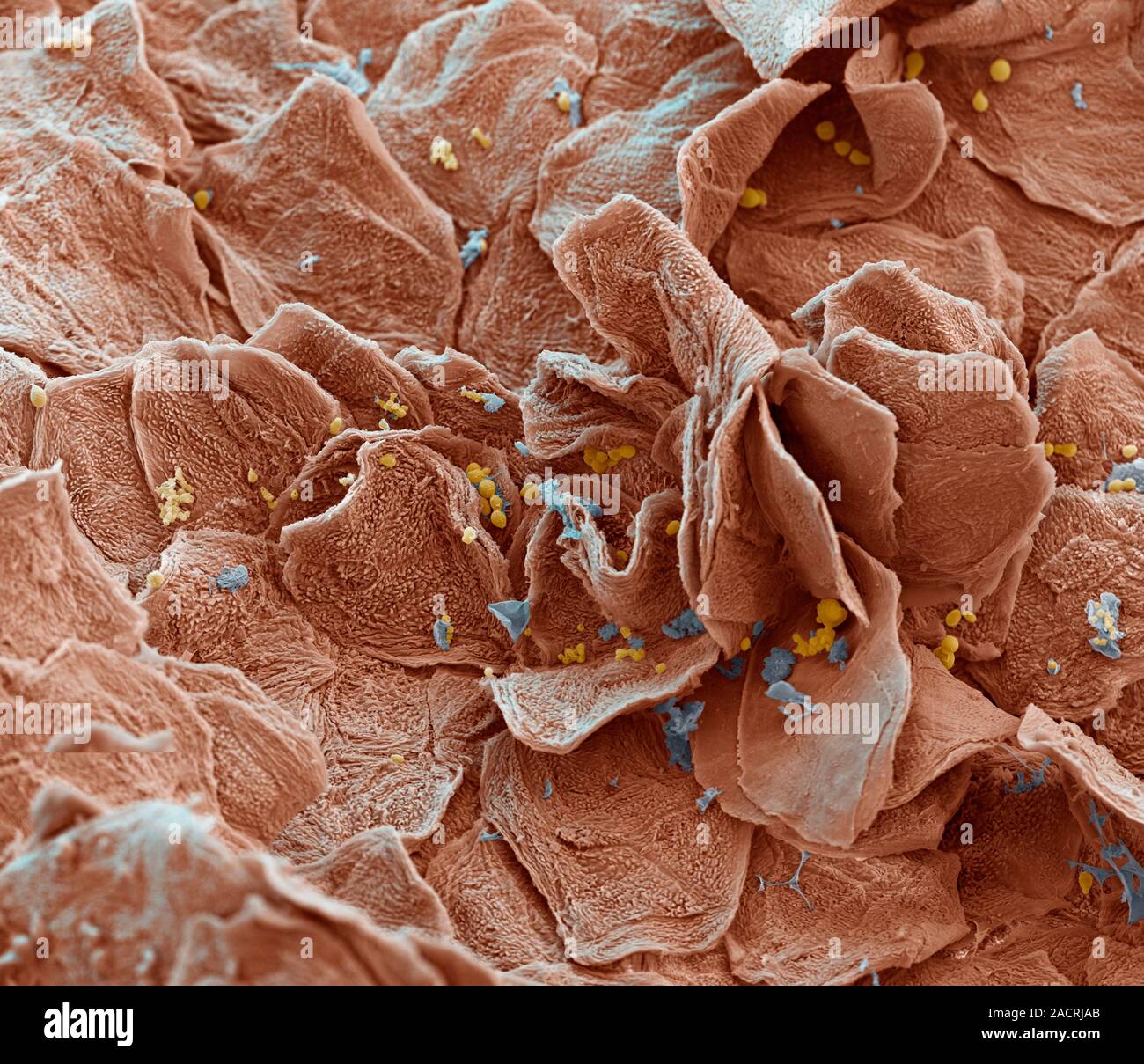 Psoriasis. Coloured scanning electron micrograph (SEM) of skin cells ...