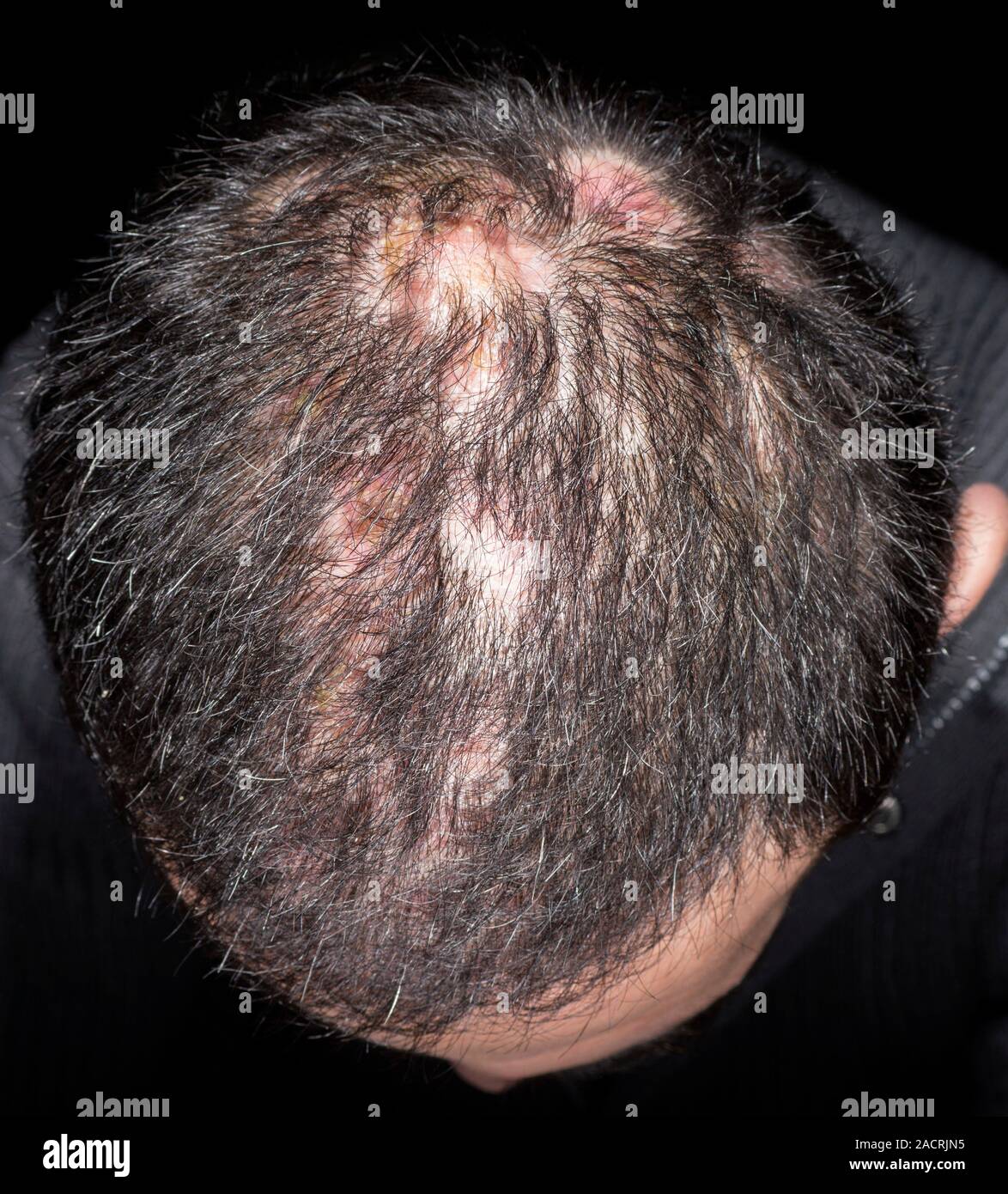 Folliculitis On Scalp Folliculitis: Diagnosis And Management Of