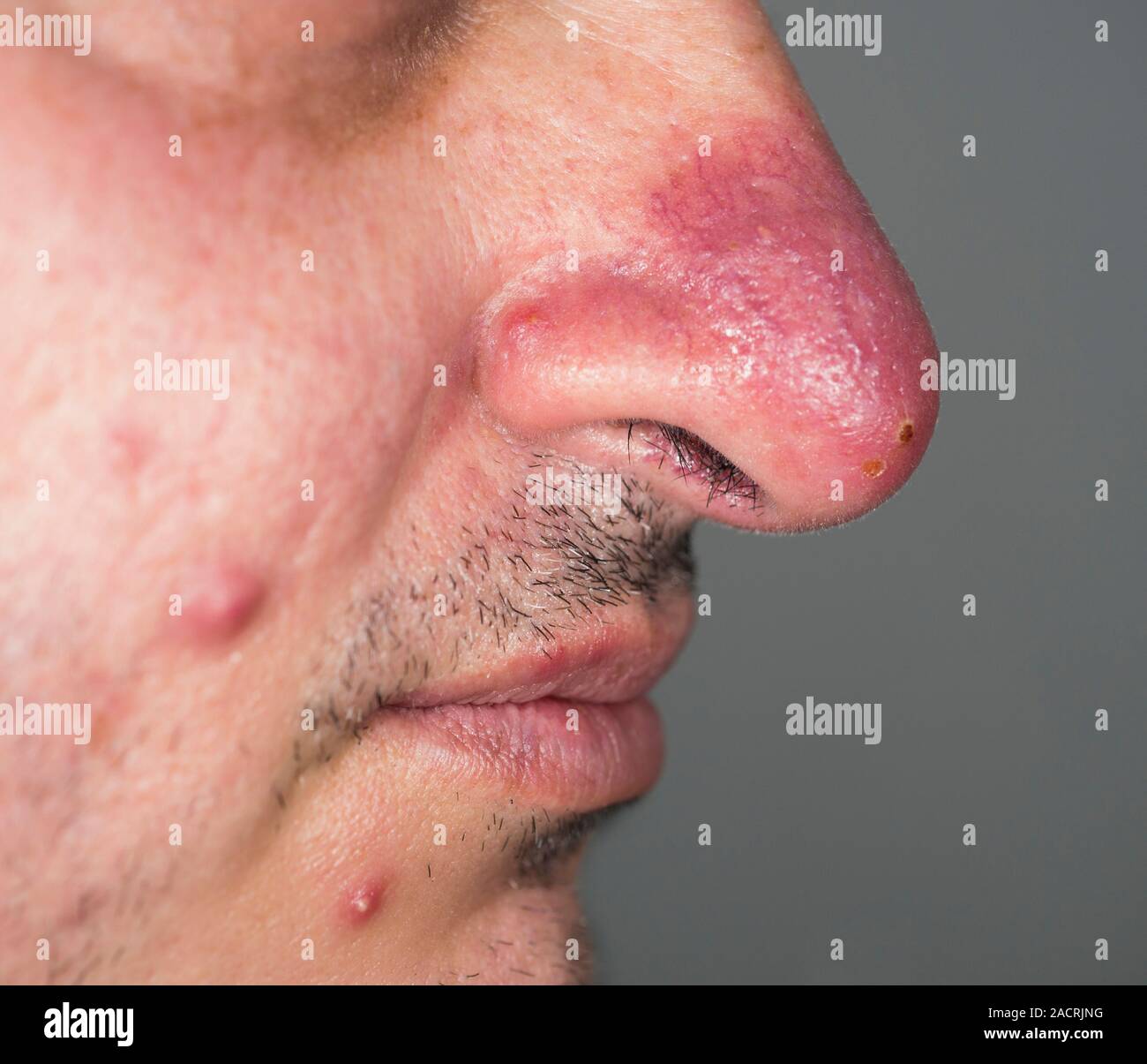 Rhinophyma of the nose of a 42-year-old man. In this dermatological ...