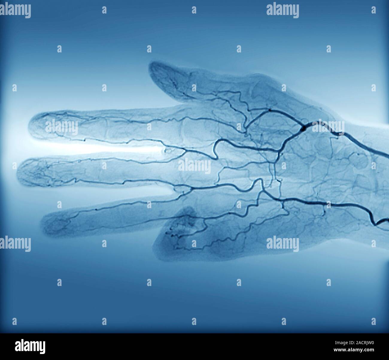 Blood supply of the hand. Coloured angiogram (X-ray) of the blood ...
