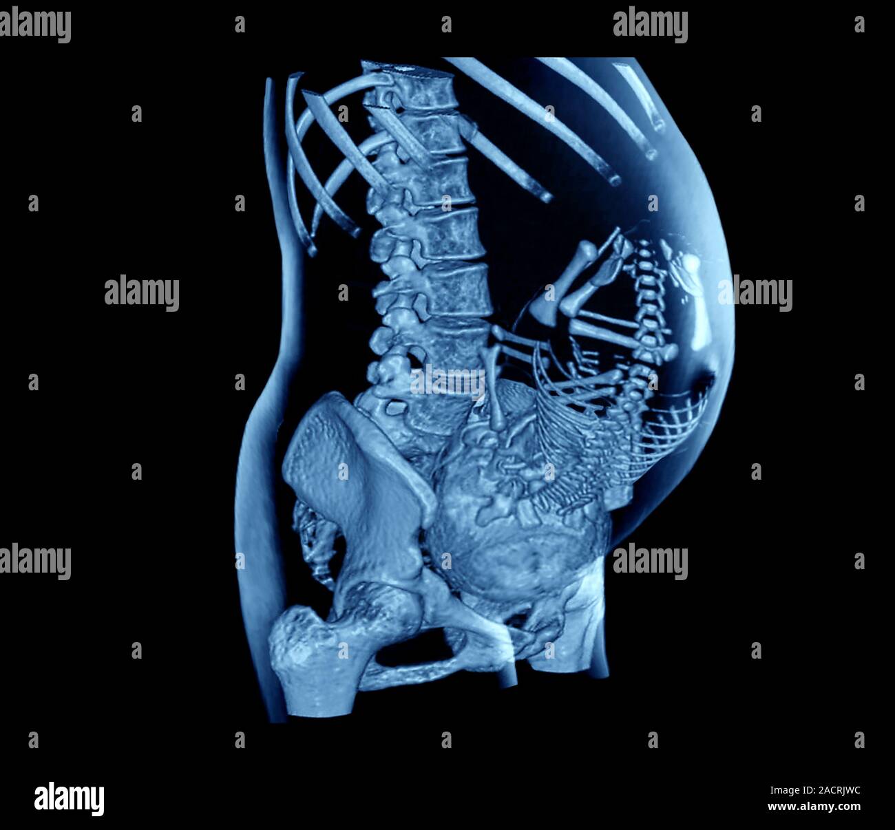 Full term foetus. Coloured 3D computed tomography (CT) scan of a full ...