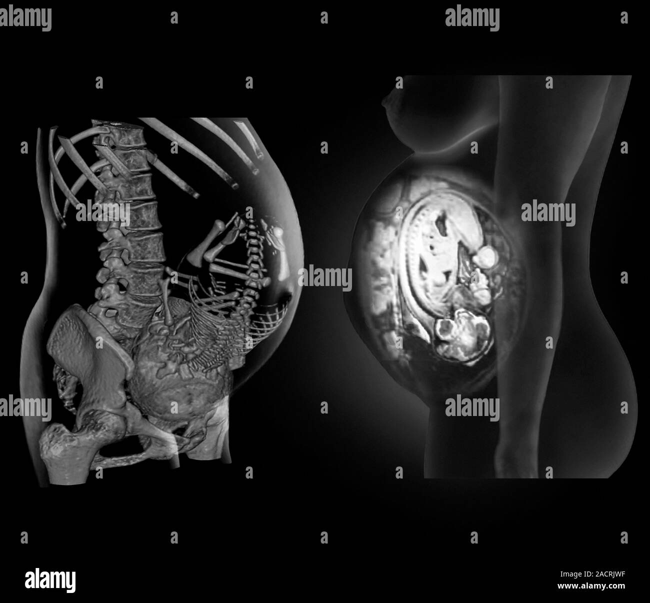 Full term foetus. 3D computed tomography (CT, left) and magnetic ...
