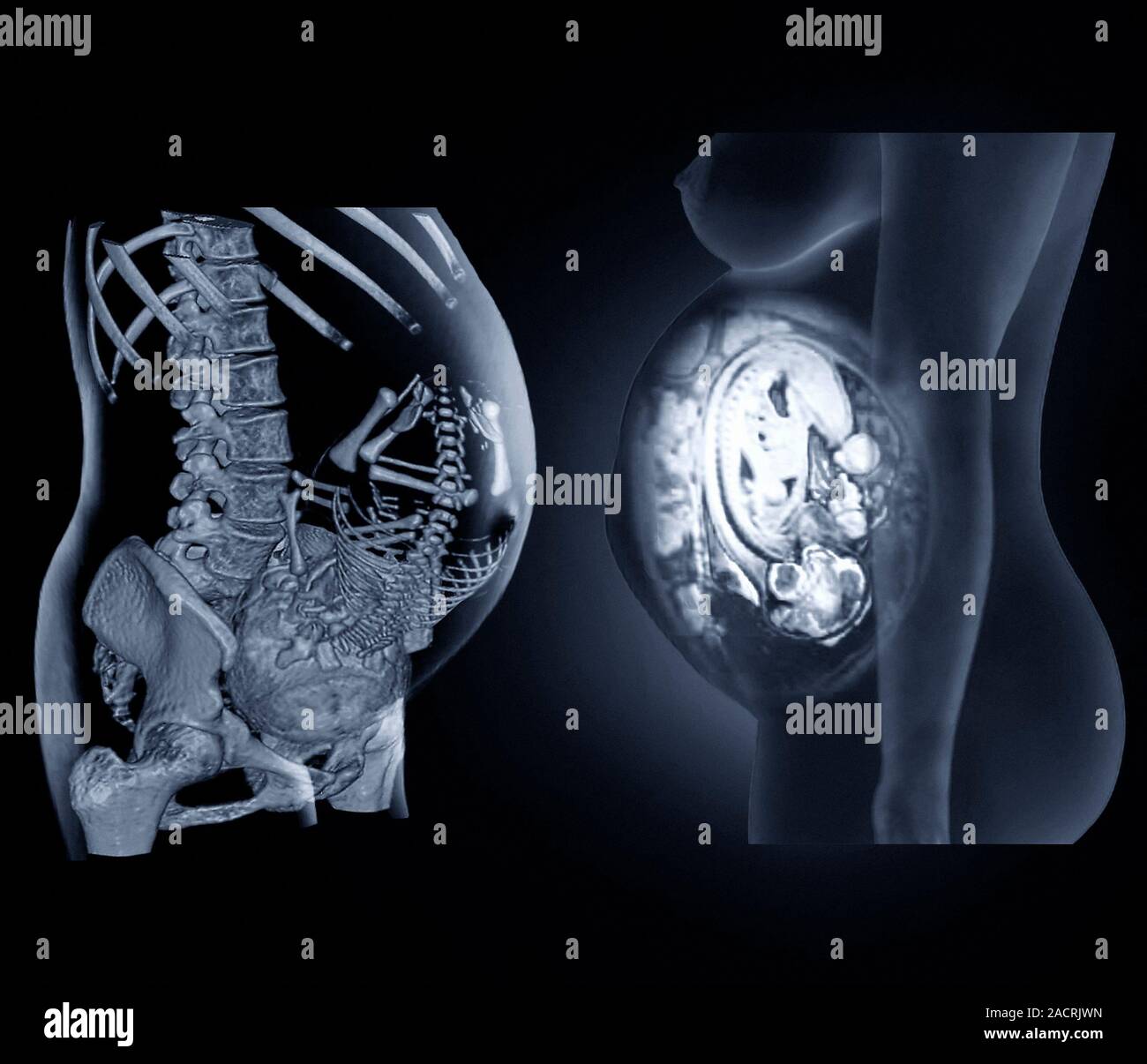 Full term foetus. Coloured 3D computed tomography (CT, left) and ...