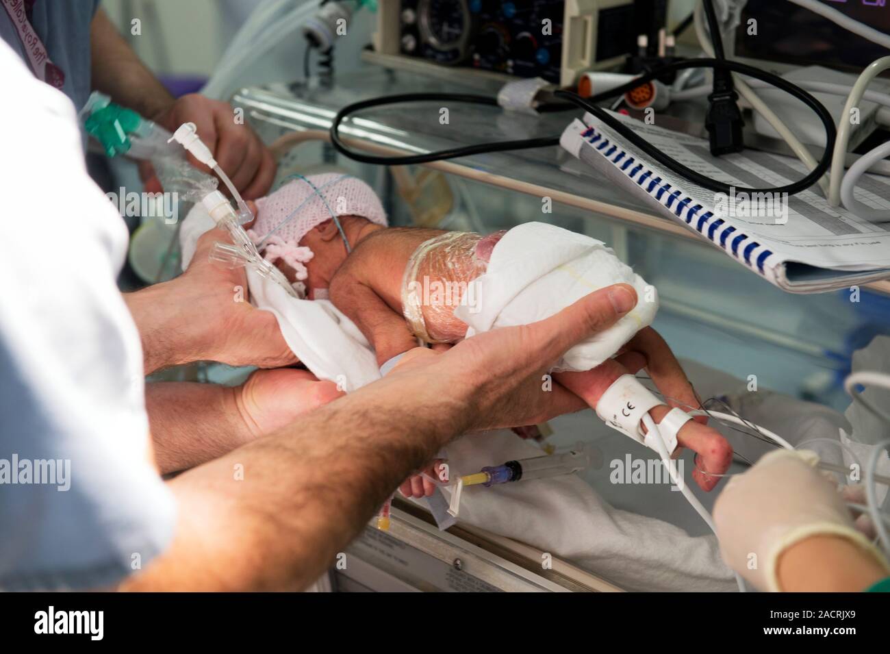 Myelomeningocele birth defect. Doctor and nurses handling a neonate ...