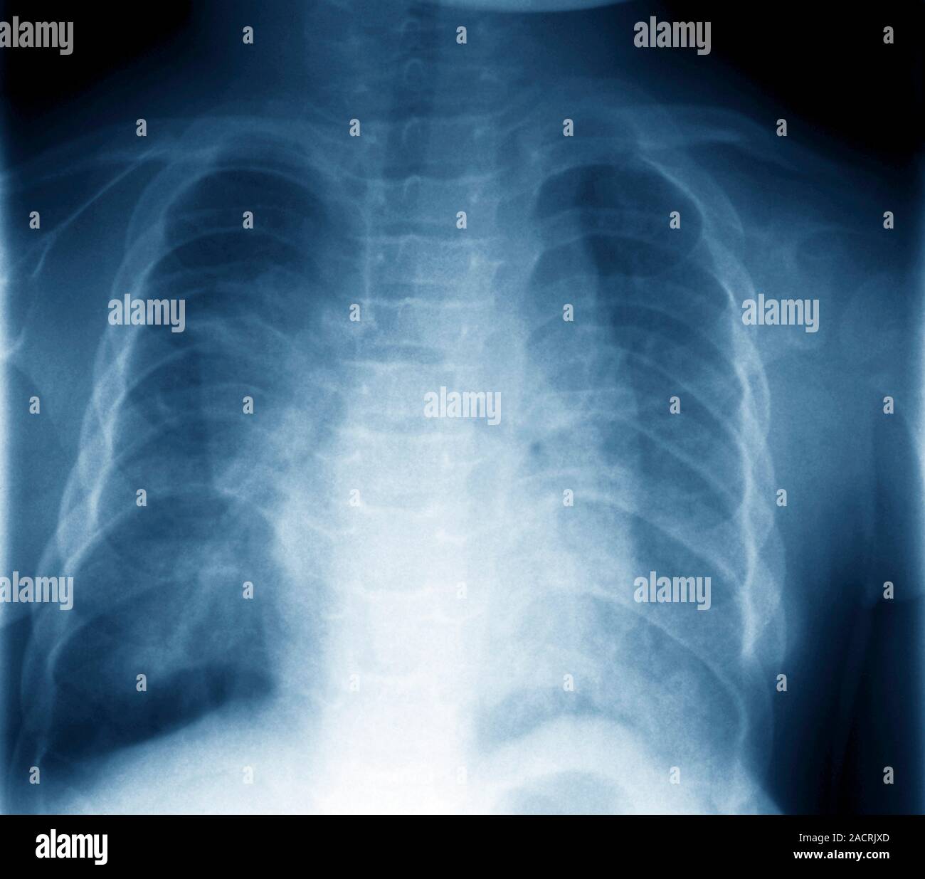 Jeune syndrome. X-ray of the chest of a 2 year old with Jeune syndrome ...