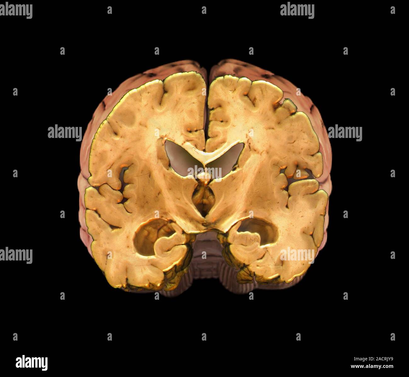 Healthy brain. Coloured 3D magnetic resonance imaging (MRI) scan of the ...