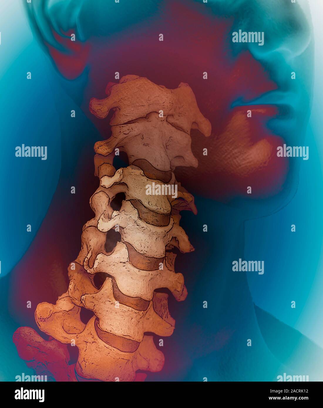 Healthy spine. Coloured 3D computed tomography (CT) scan of the ...