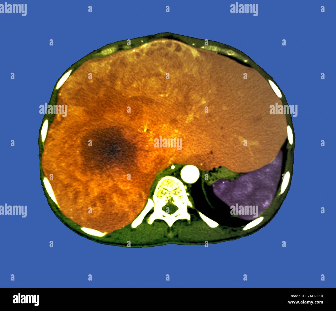 Liver cancer. Coloured computed tomography (CT) scan of the abdomen of a 50 year old alcoholic ...