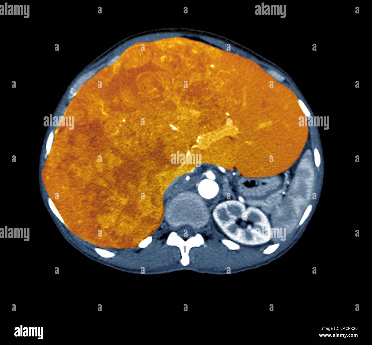 Liver cancer. Coloured computed tomography (CT) scan of the abdomen of ...