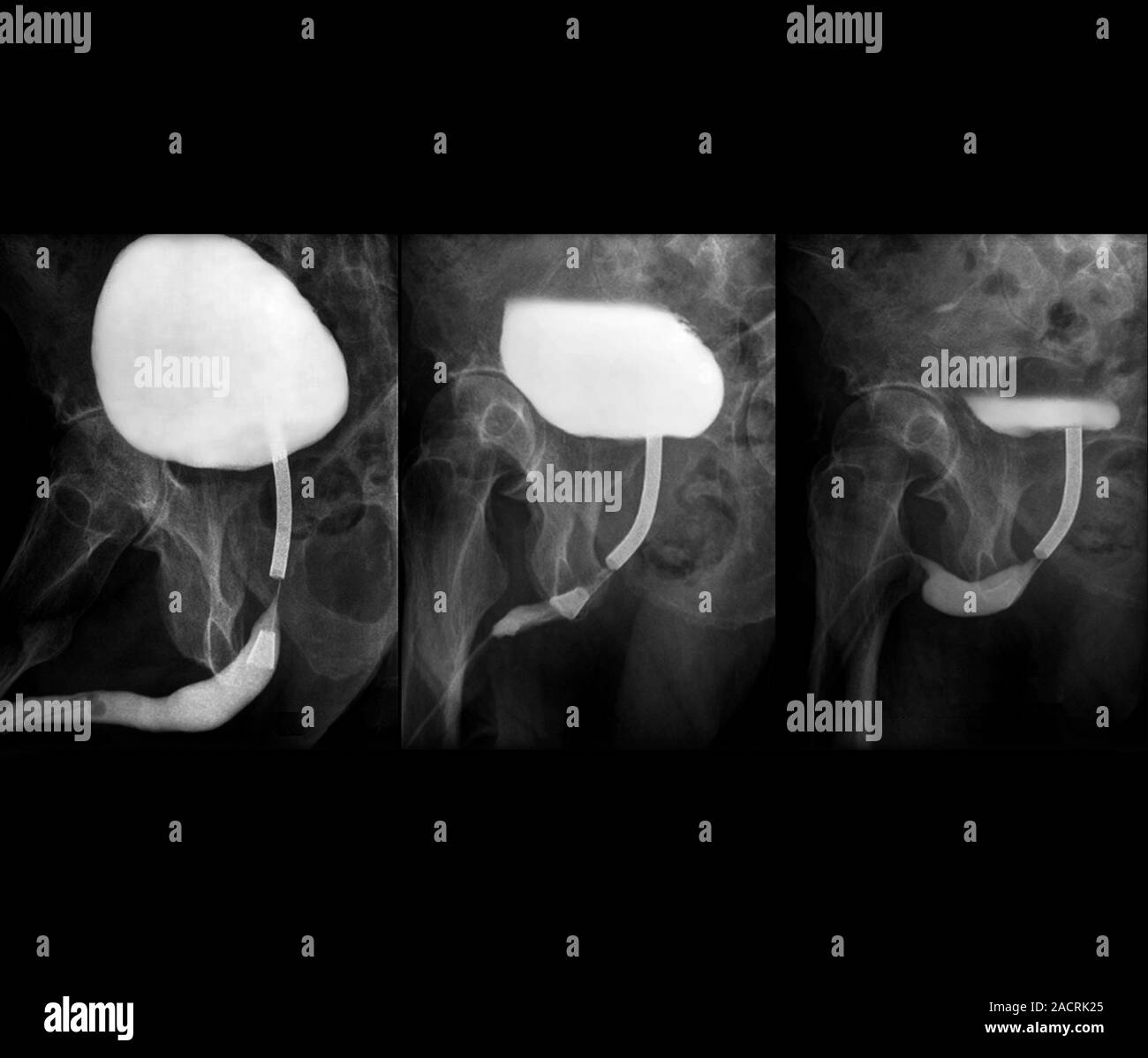 Voiding cystourethrogram. Three X-rays showing a 65 year old patient ...