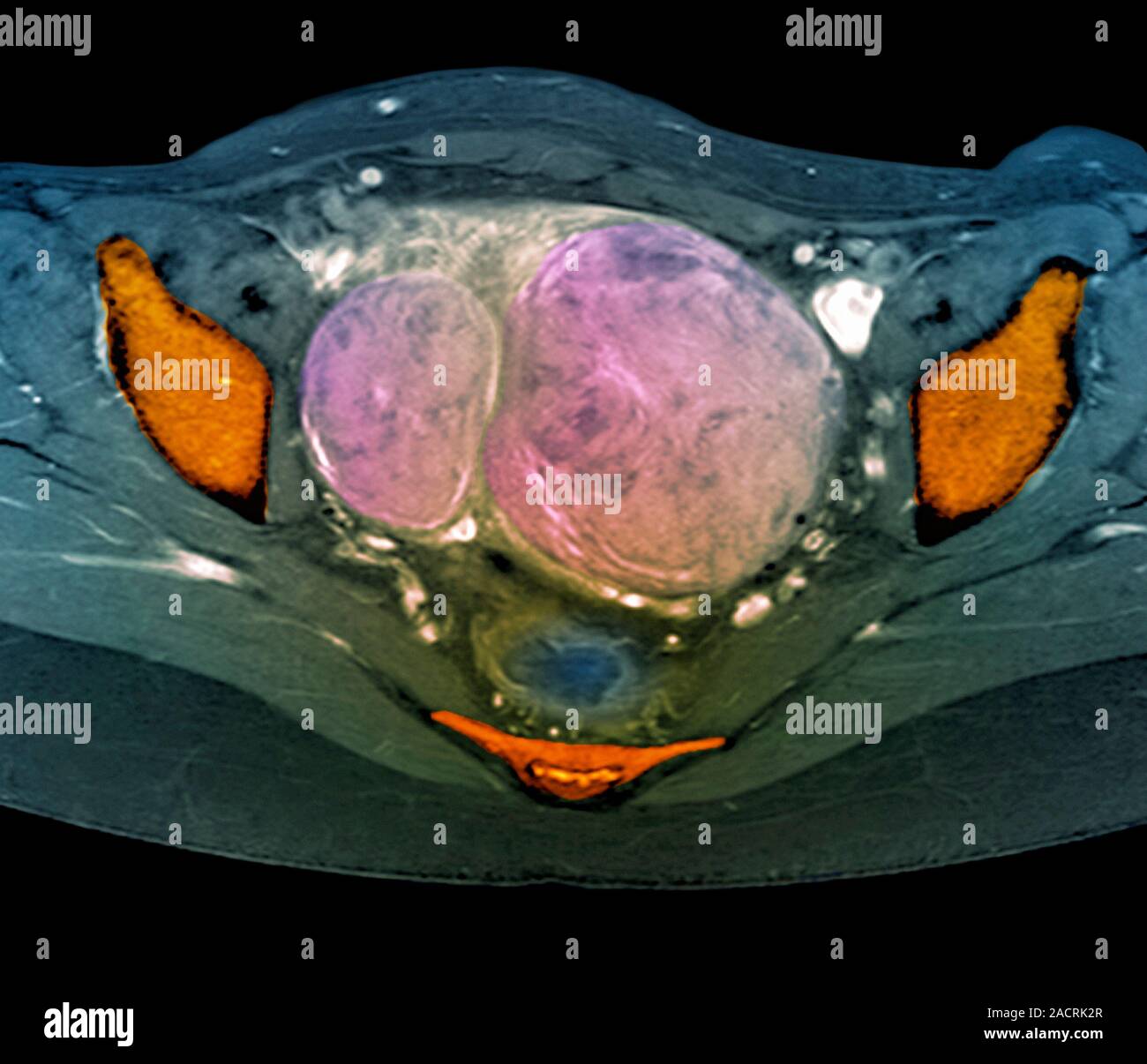 Uterine fibroids. Coloured magnetic resonance imaging (MRI) scan of the ...
