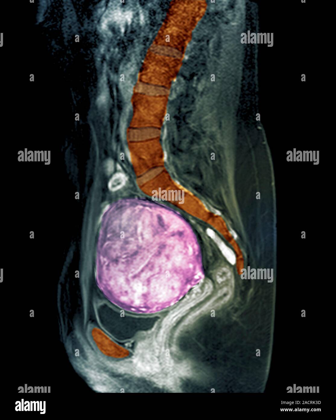 Uterine Fibroids Coloured Magnetic Resonance Imaging Mri Scan Of The Pelvis Of A 47 Year Old