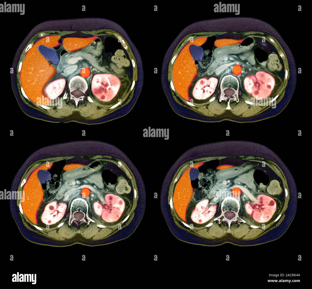 Kidney infection. Coloured computed tomography (CT) scans of the abdomen of a 57 year old ...