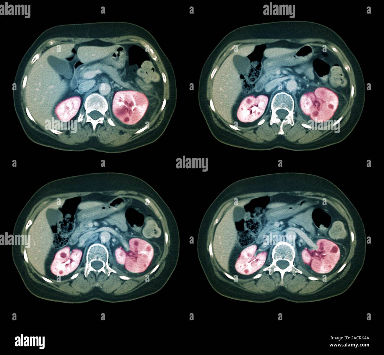 Kidney infection. Coloured computed tomography (CT) scans of the ...