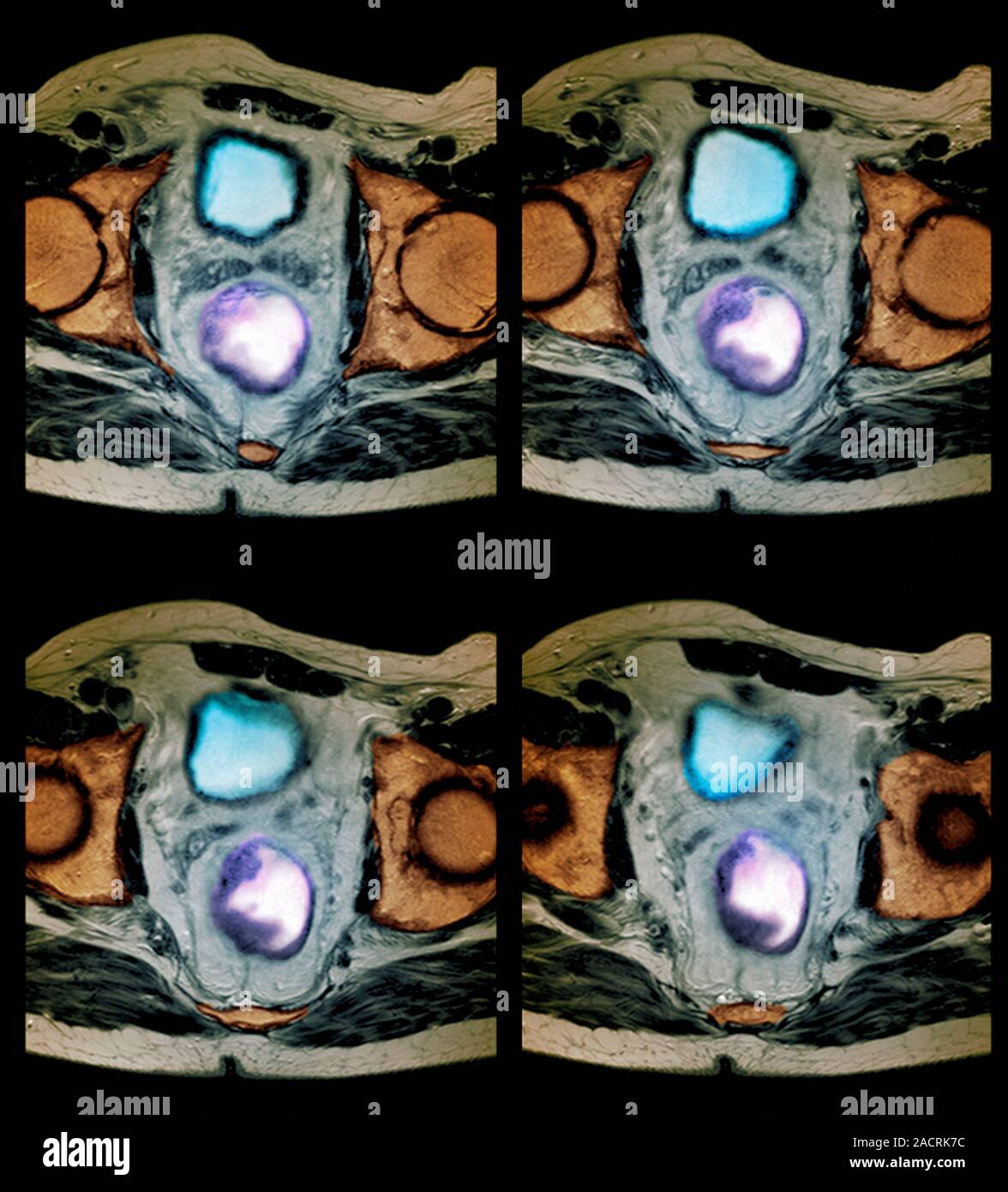 Rectal cancer. Coloured magnetic resonance imaging (MRI) scans of the ...