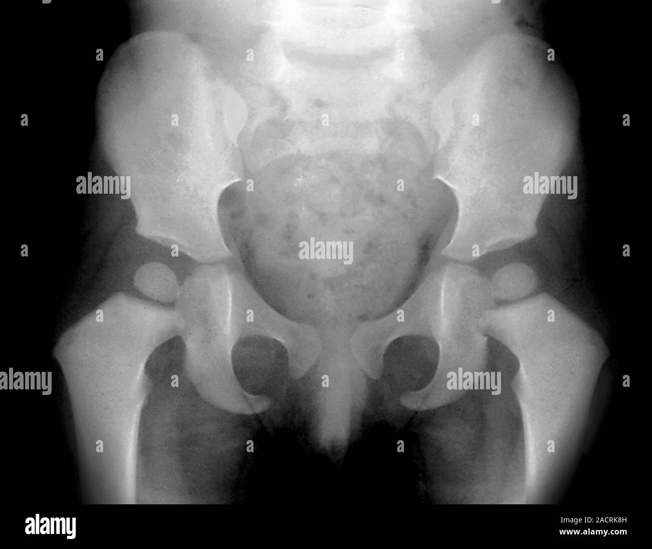 Seventeen month old baby's pelvis, X-ray. The hip joints (centre right ...