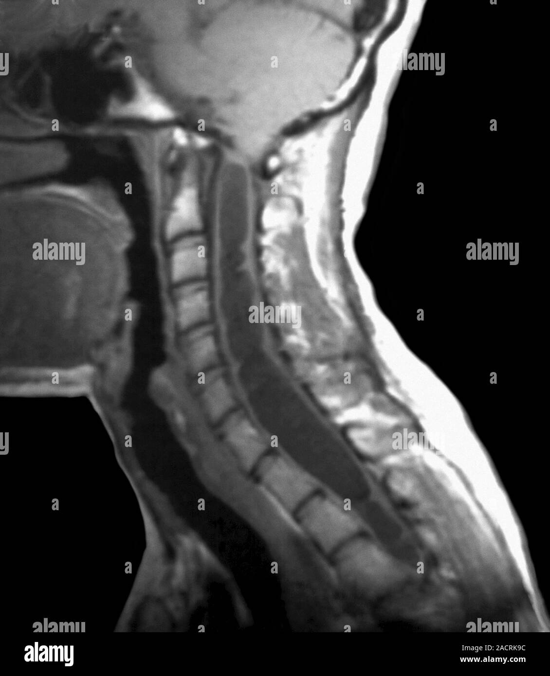 Spinal cord cyst. Magnetic resonance imaging (MRI) scan of the cervical ...
