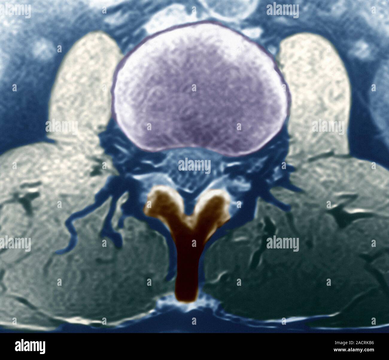 Healthy lumbar spine. Coloured magnetic resonance imaging (MRI) scan ...
