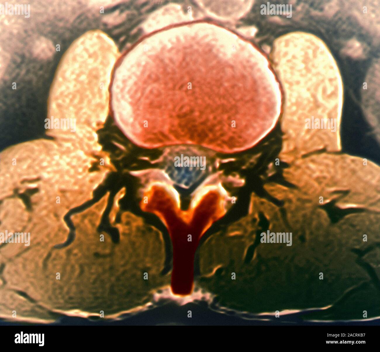 Healthy lumbar spine. Coloured magnetic resonance imaging (MRI) scan ...