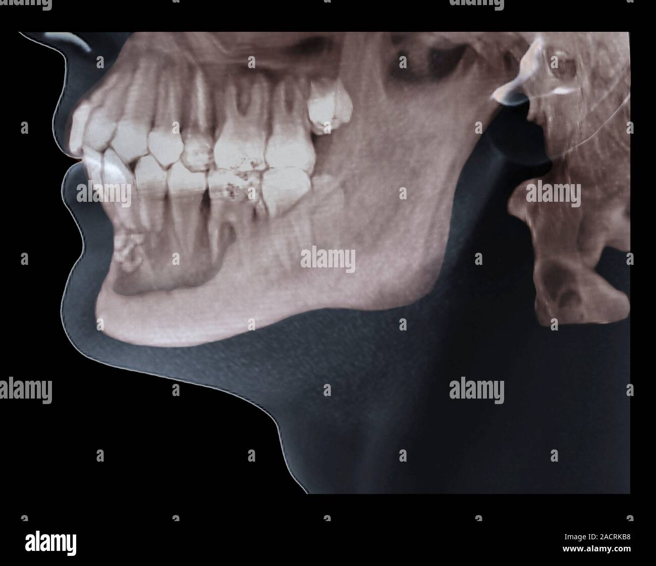 Jaw tumour. Coloured 3D computed tomography (CT) scan of the jaw of a ...