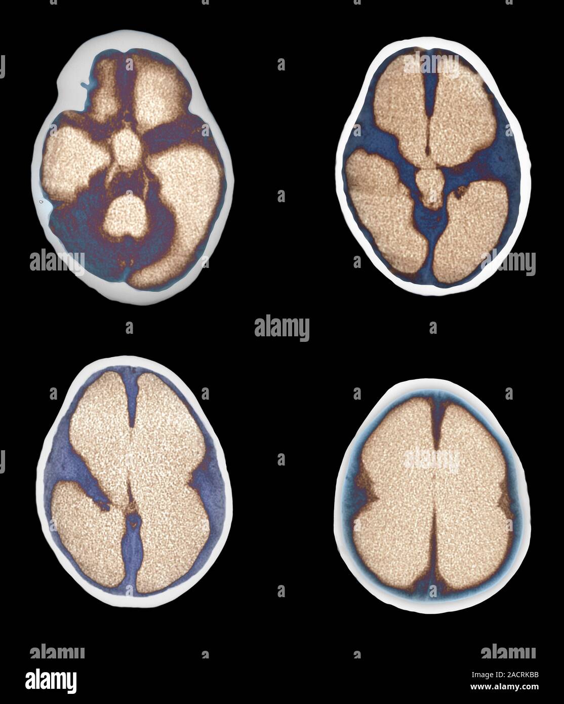 Hydrocephalus. Coloured computed tomography (CT) scans of the brain of ... Hydrocephalus. Coloured computed tomography (CT) scans of the brain of ...