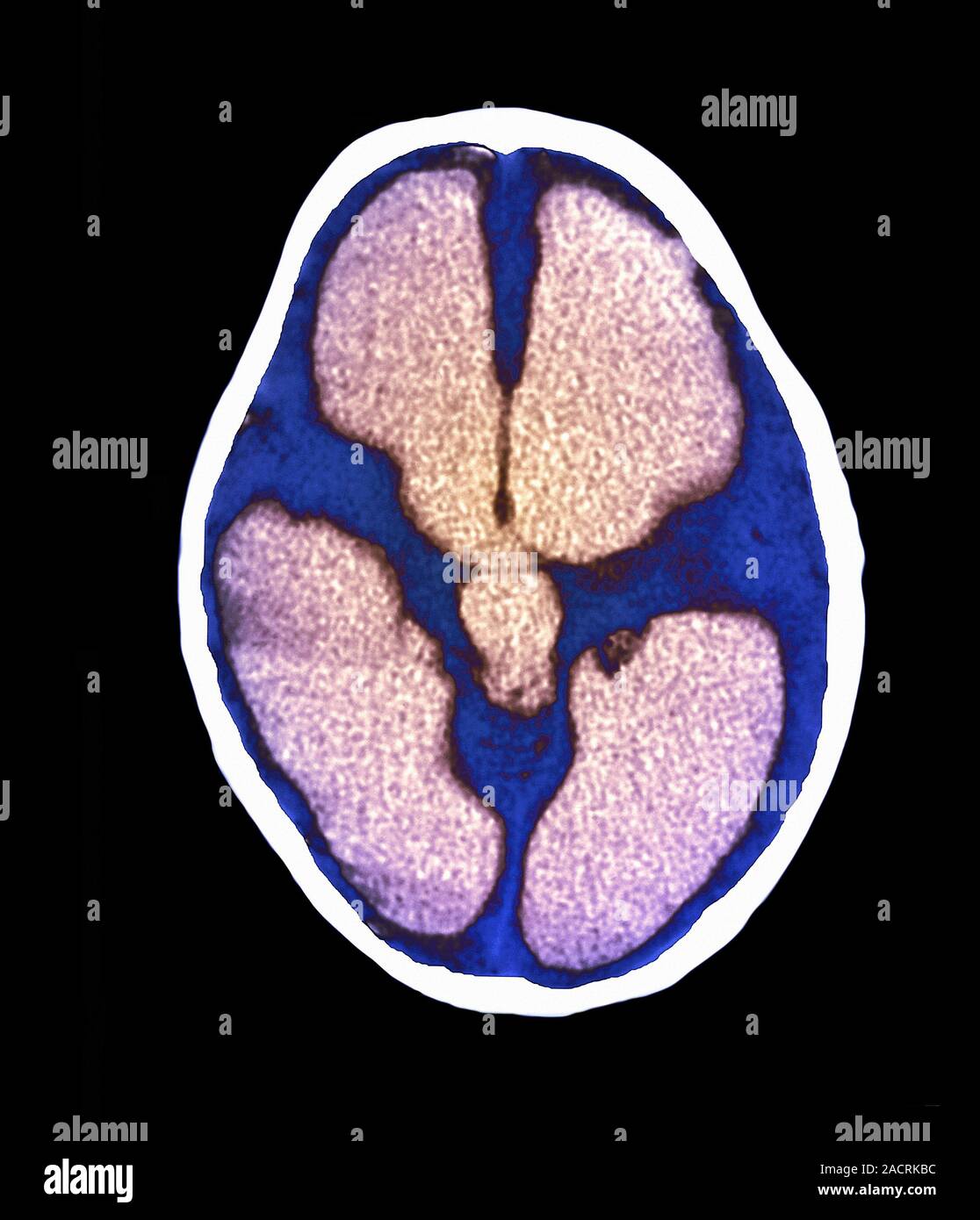 Hydrocephalus. Coloured computed tomography (CT) scan of the brain of a 22 year old patient with ...