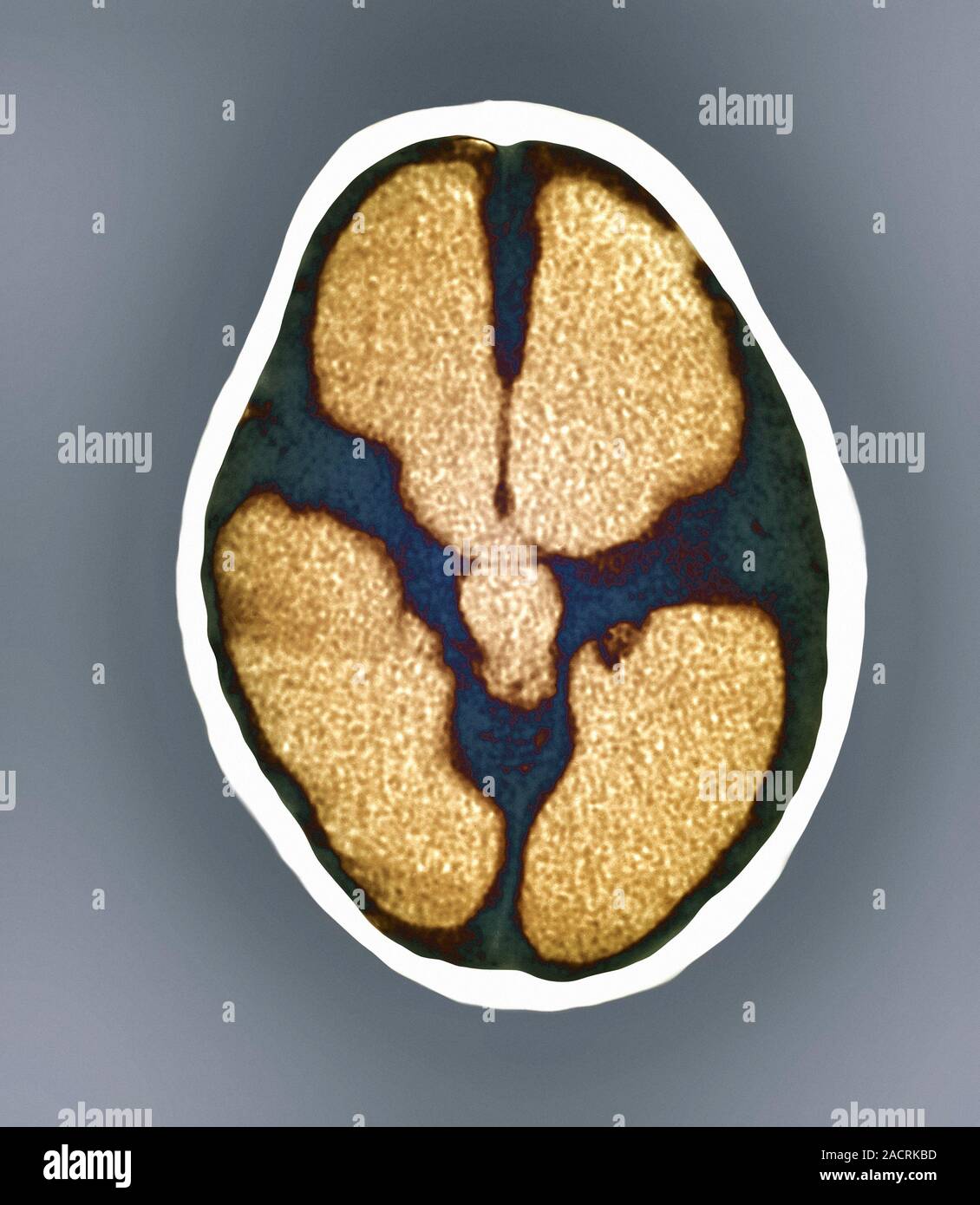 Hydrocephalus. Coloured computed tomography (CT) scan of the brain of a ... Hydrocephalus. Coloured computed tomography (CT) scan of the brain of a ...