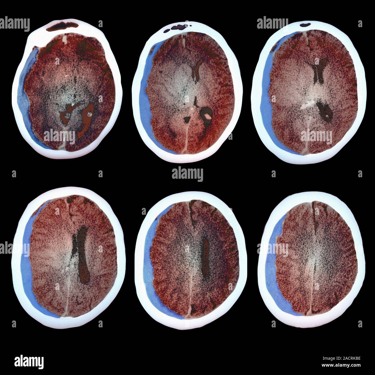 Brain haemorrhage. Coloured computed tomography (CT) scans of the brain of a 49 year old patient ...