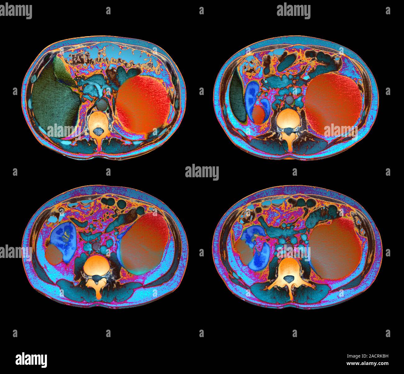 Polycystic kidneys. Coloured computed tomography (CT) scans of the ...