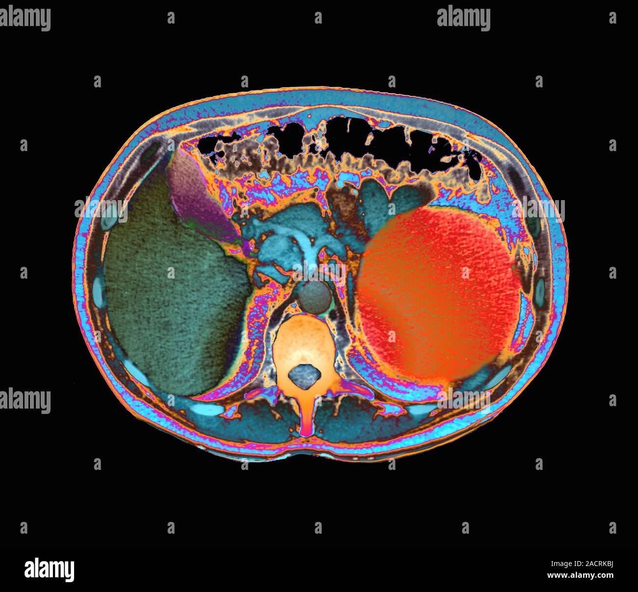 Polycystic kidneys. Coloured computed tomography (CT) scan of the ...