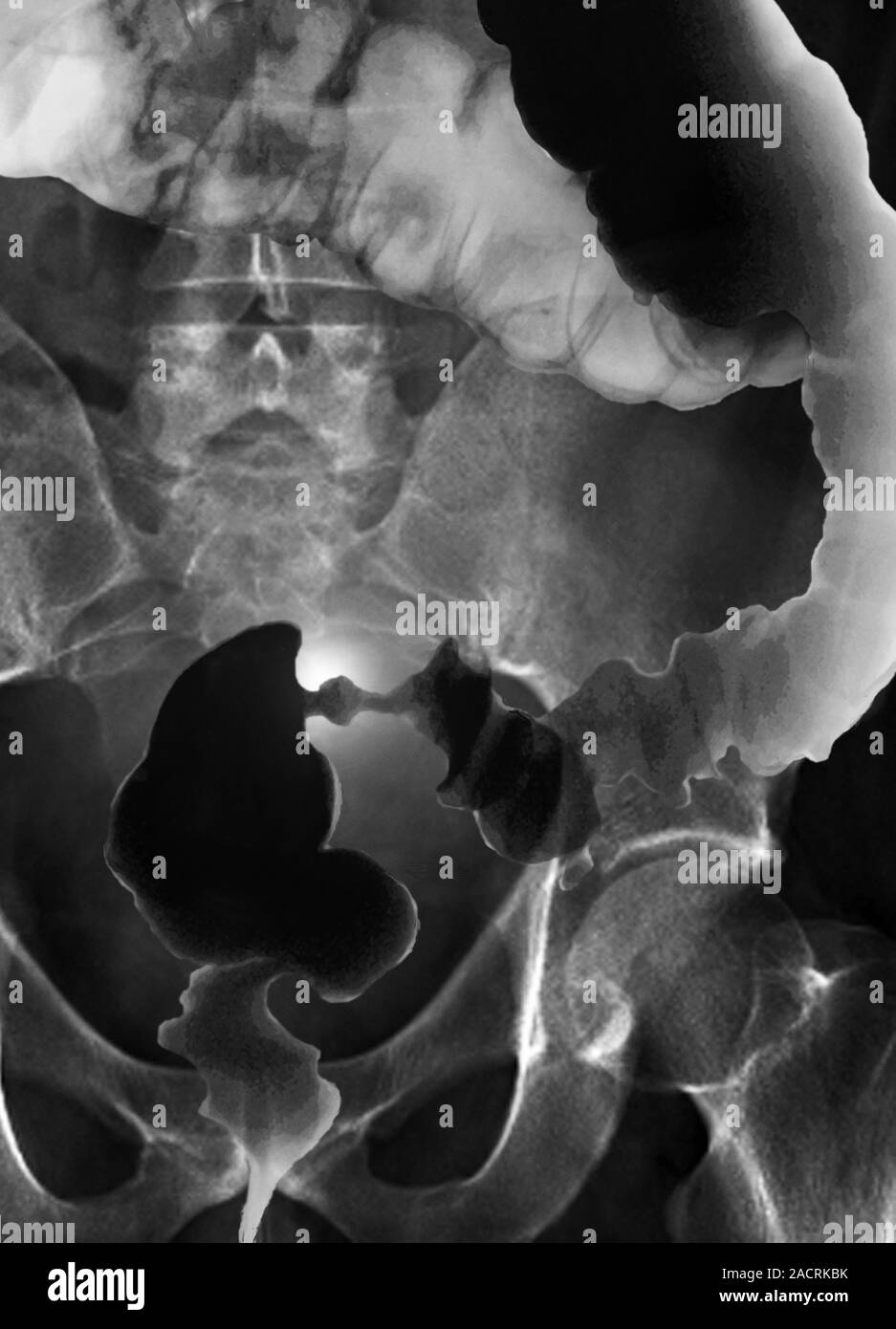 Colon cancer. X-ray of the large intestine of a 62 year old patient ...