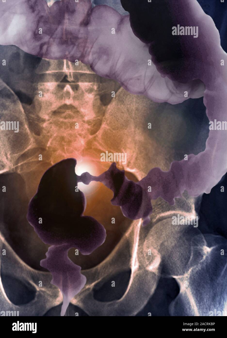 Colon cancer. Coloured X-ray of the large intestine of a 62 year old ...