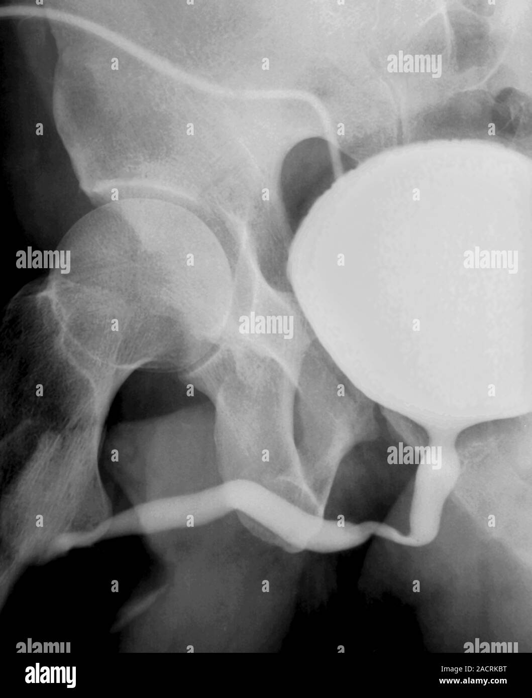 Voiding cystourethrogram. X-ray of a 54 year old male patient ...