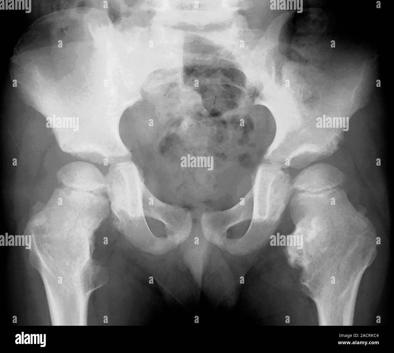 Bone growths. X-ray of the pelvis of a 12 year old patient with bony ...