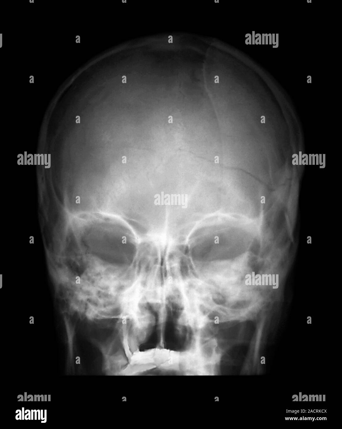 Fractured skull, X-ray. The fracture is the grey line at right that ...