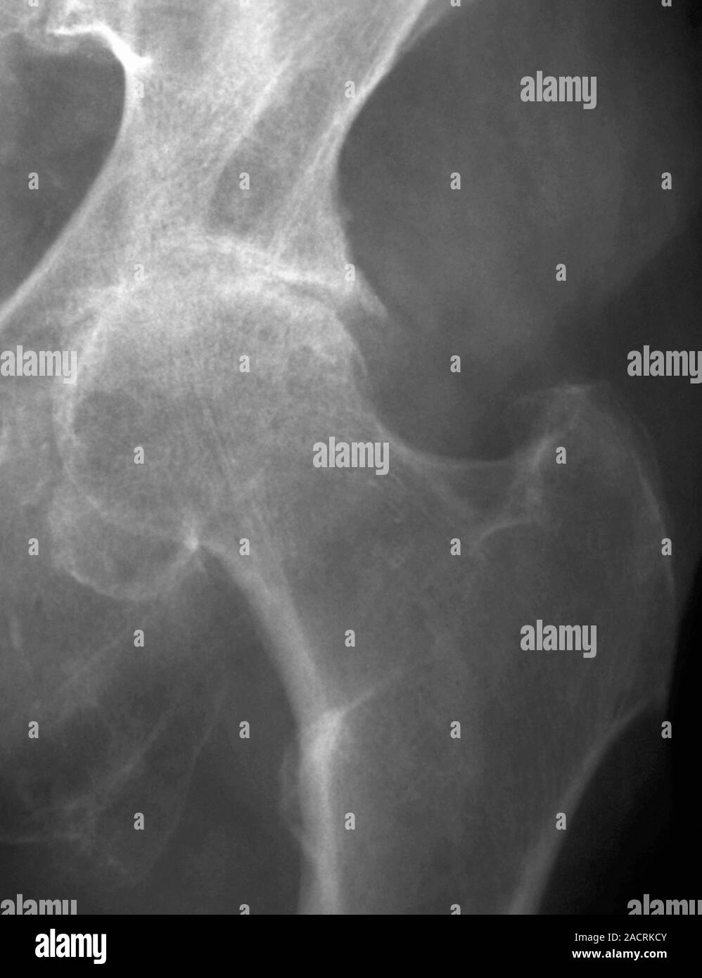 Osteoarthritis Of The Hip X Ray The Left Hip Of A 74 Year Old Patient Showing Osteoarthritis