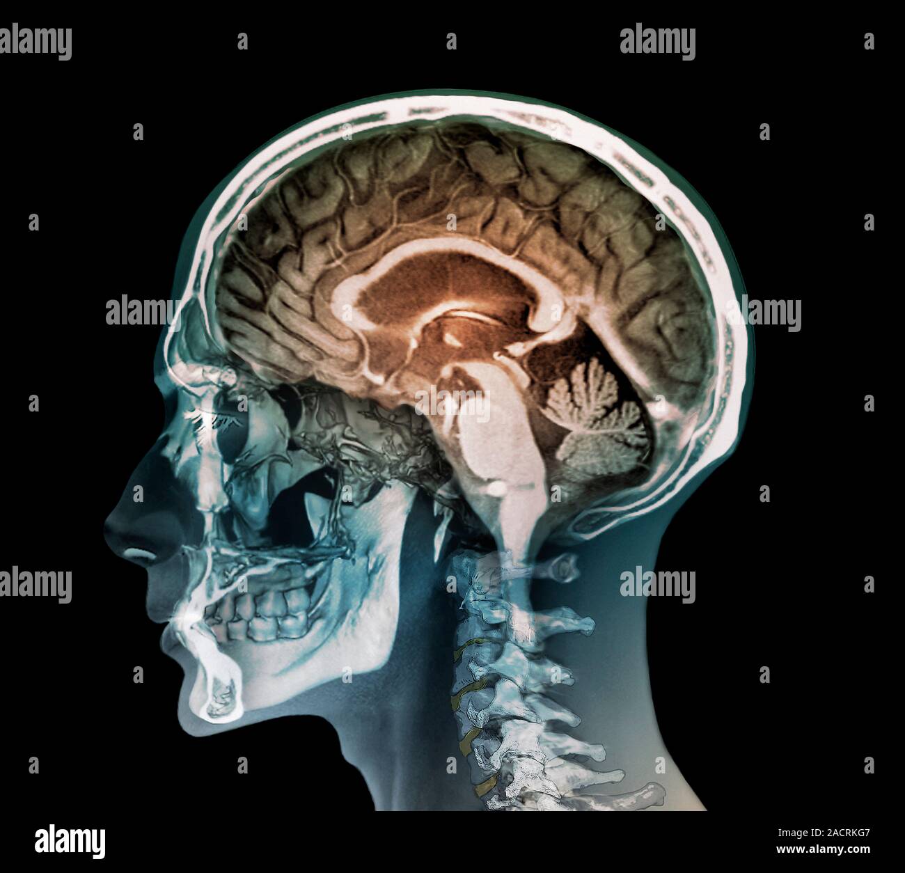 Human head. Coloured composite image of a magnetic resonance imaging ...