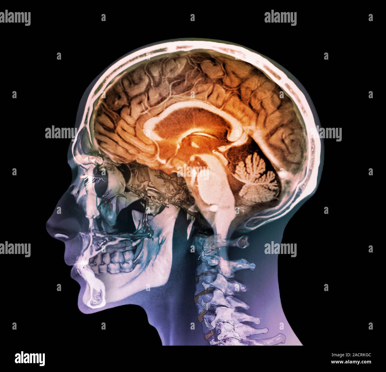Human head. Coloured composite image of a magnetic resonance imaging (MRI) scan of the brain and ...
