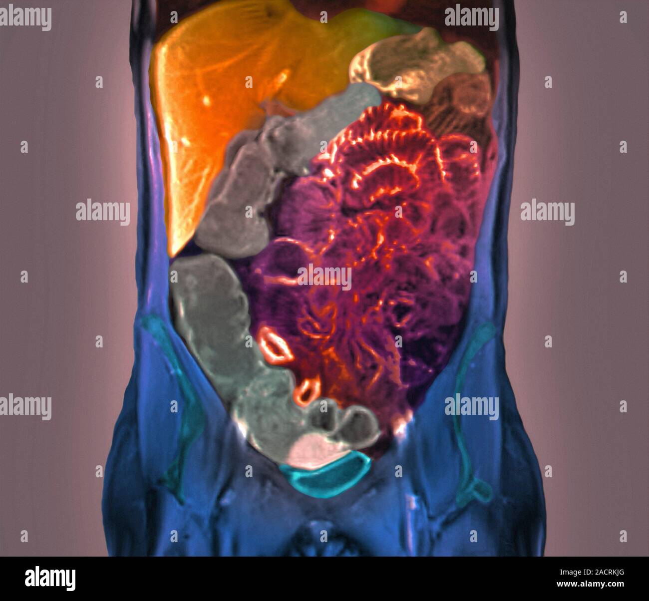 Healthy abdomen. Coloured magnetic resonance imaging (MRI) scan of the ...