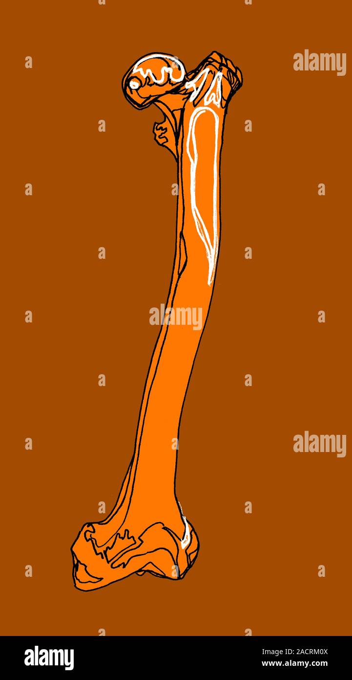 Rickets. Illustration of a femur (thigh bone) that has become curved ...
