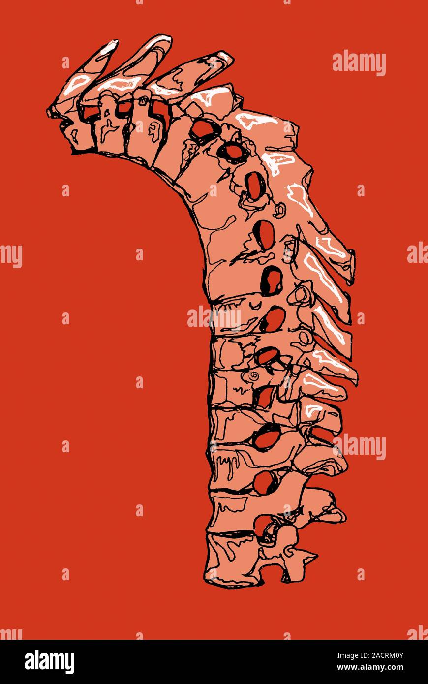 Dowager's hump. Illustration of a spine exhibiting hyperkyphosis, or ...