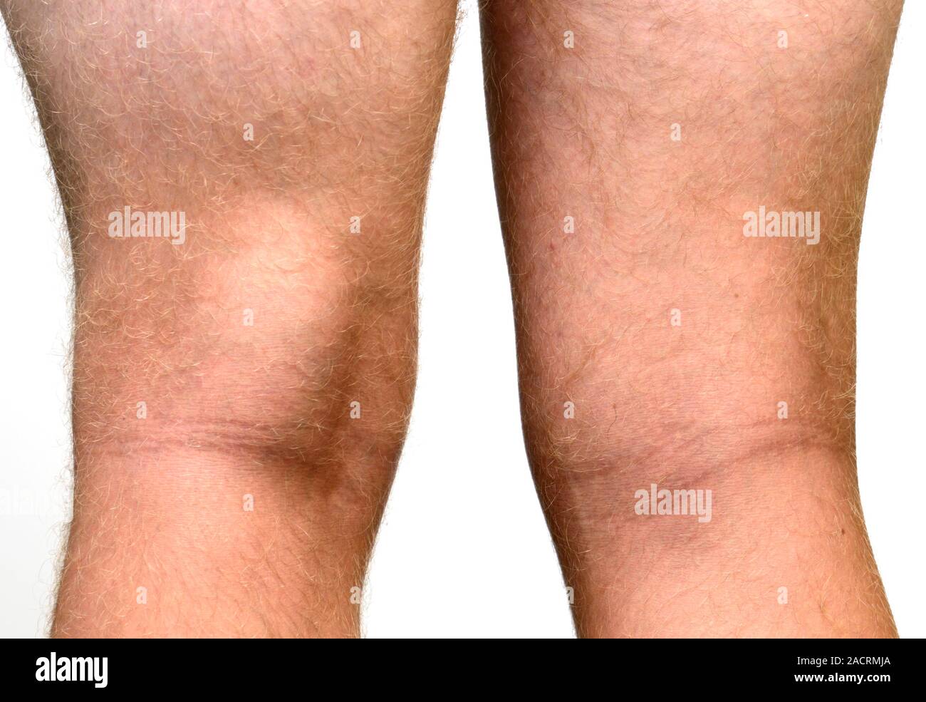 Not for use in Television Not for use in Television Baker's cyst ...