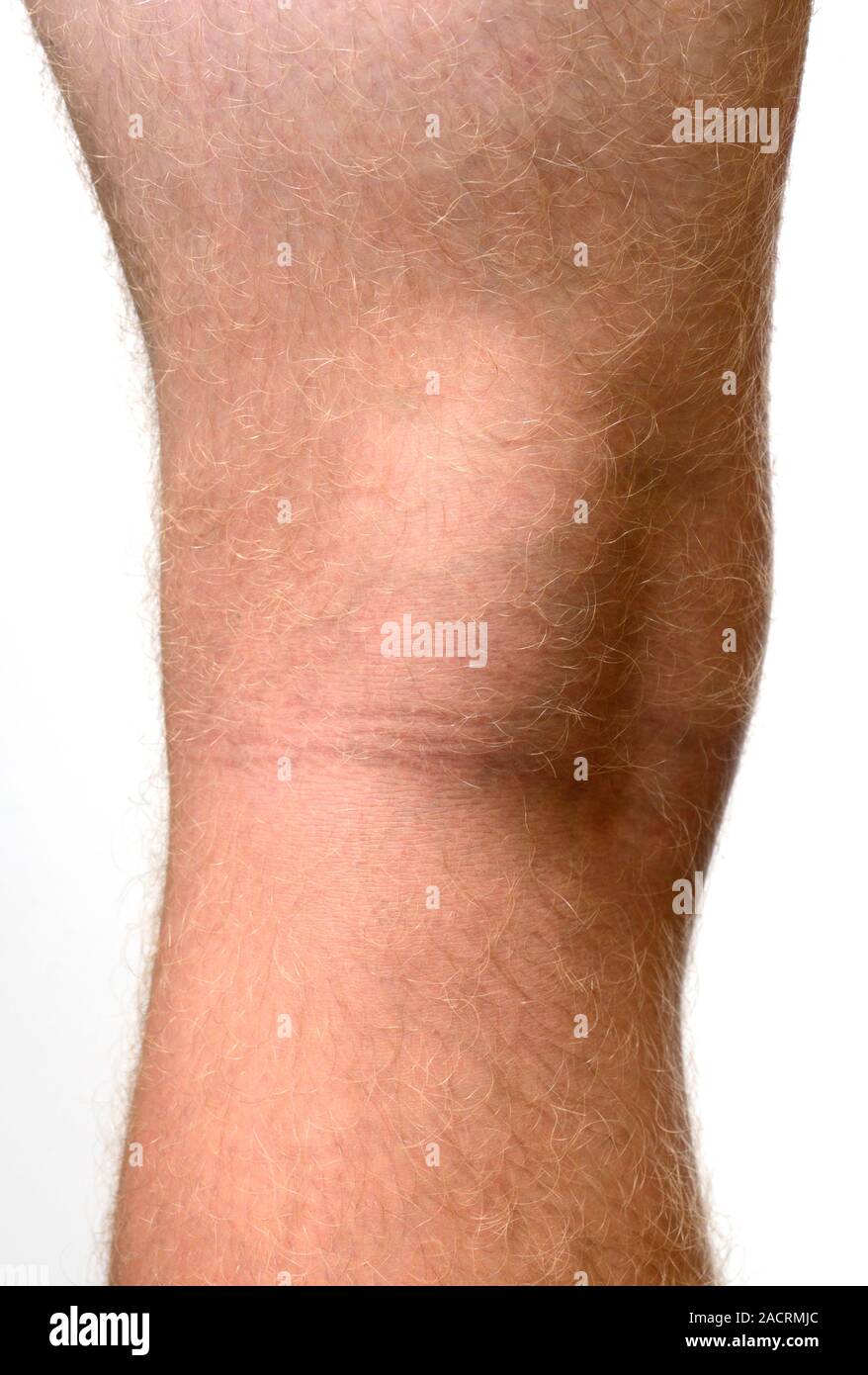 Not for use in Television Not for use in Television Baker's cyst ...