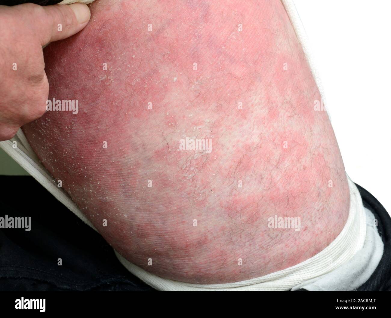 Not for use in Television Not for use in Television Eczema on the left ...