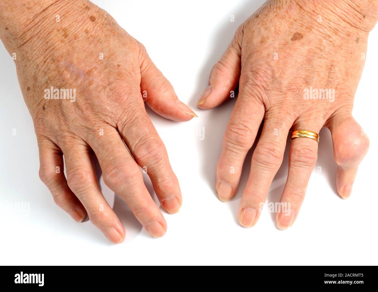 Not for use in Television Not for use in Television Gout tophus on a ...