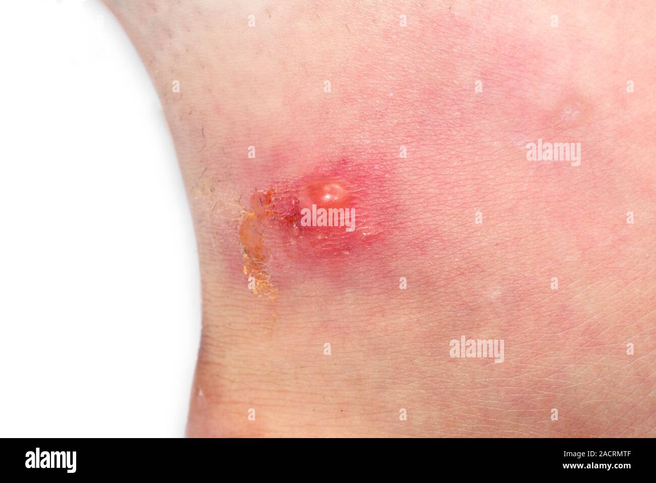 Not for use in Television Not for use in Television Cellulitis caused ...