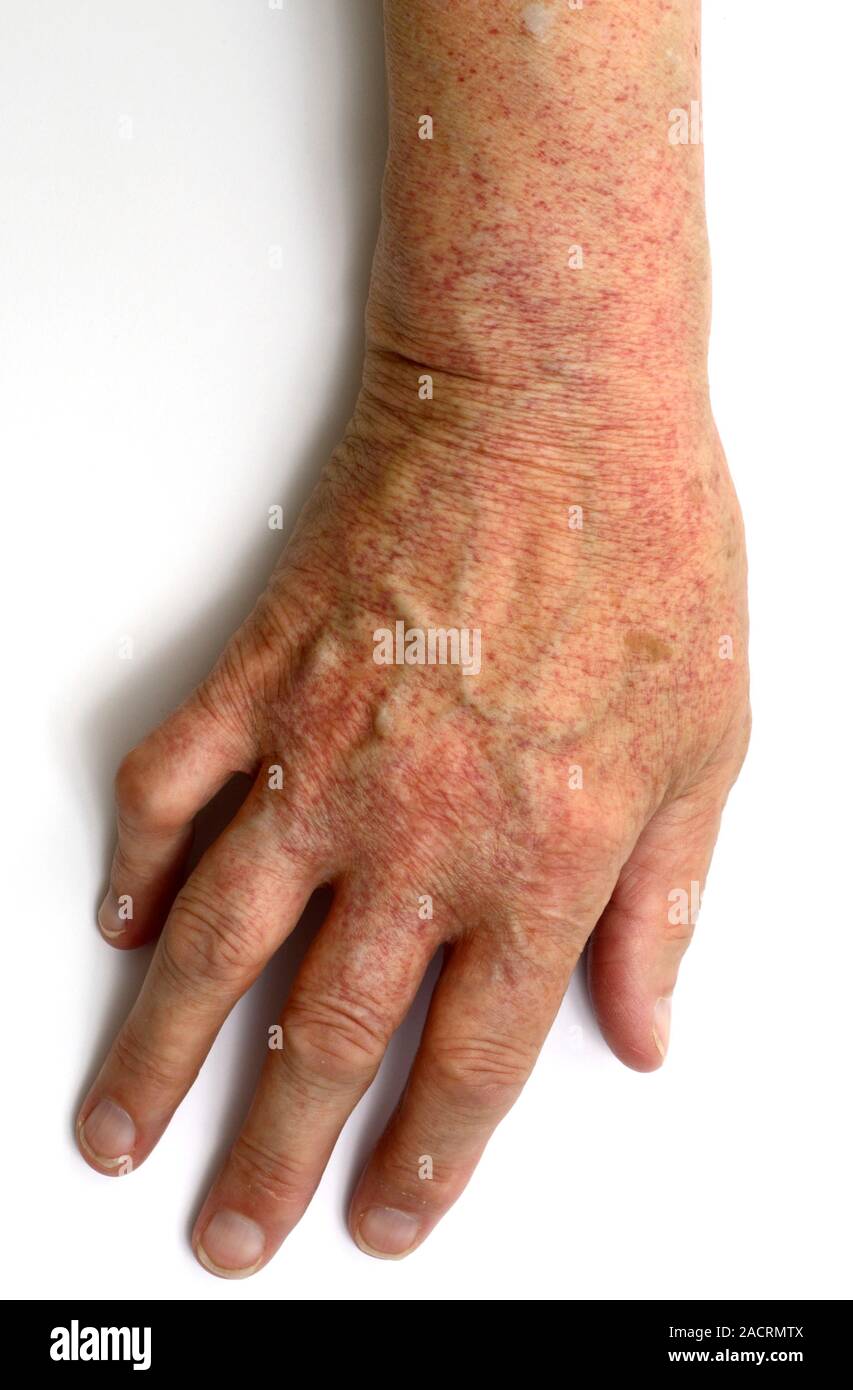 Not for use in Television Not for use in Television Purpura rash on the ...