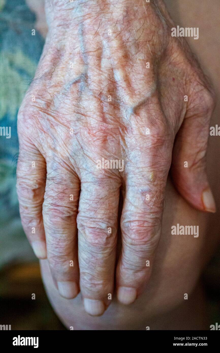 The process of aging of human skin - wrinkled hands of a very old man ...