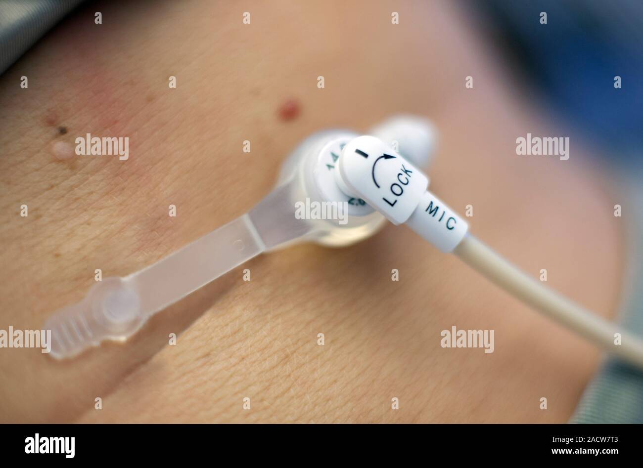 What Is A Gastric Feeding Tube at Michael Oglesby blog